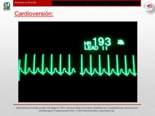 Arritmias en post operatorio | PPTX