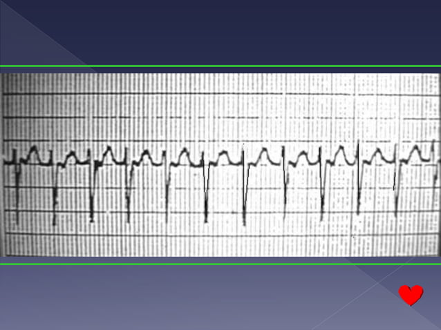 Arritmias cardiacas ACLS