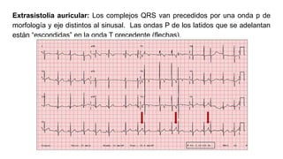 ARRITMIAS MAS FRECUENTES EN PEDIATRÍA.pptx