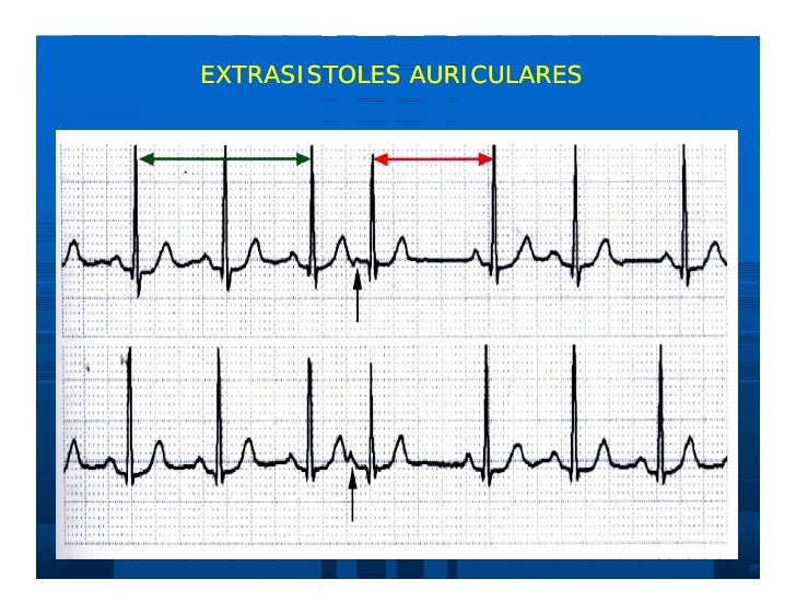 Arritmias Supra 2009