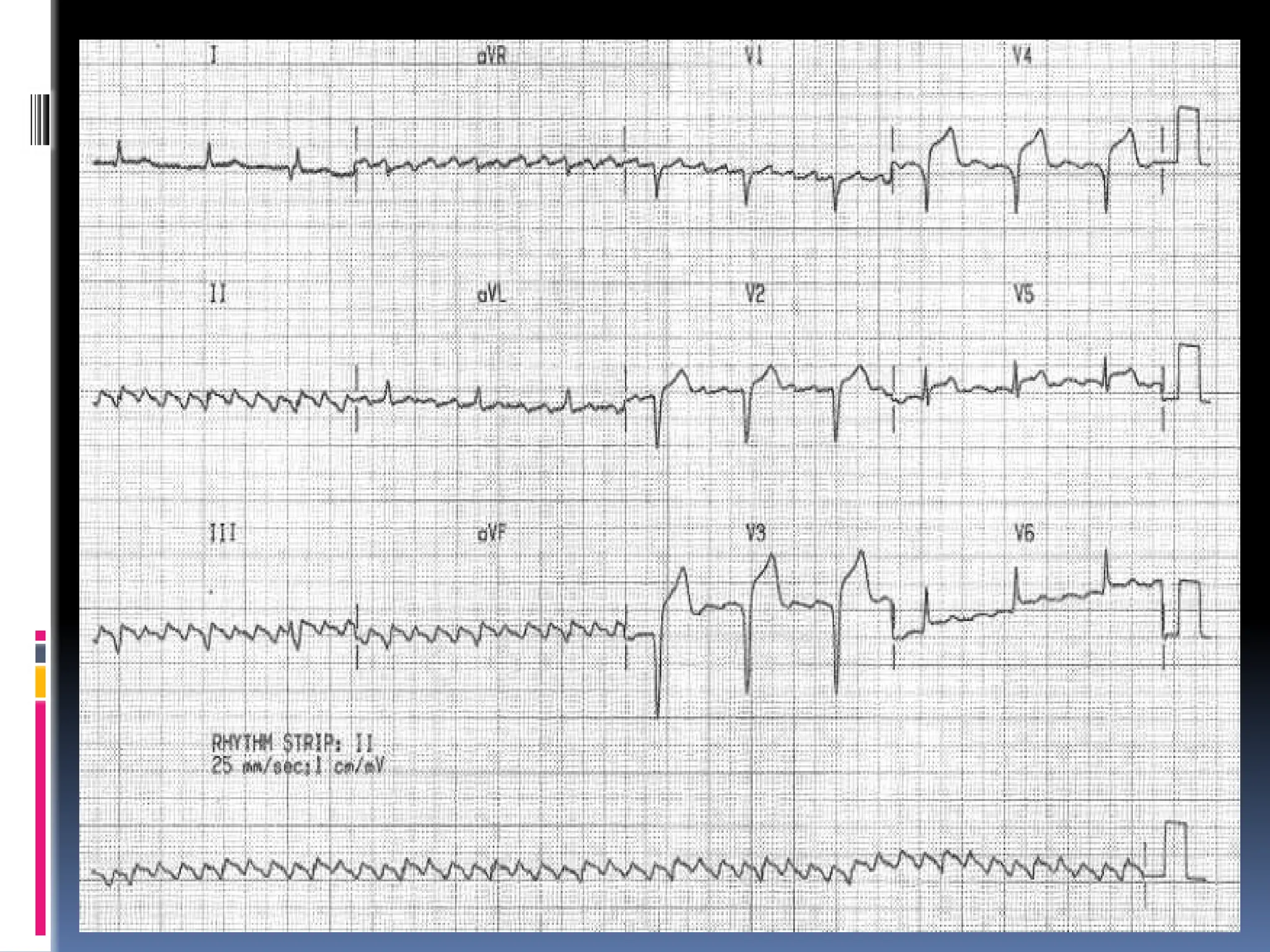 ARRITMIAS SUPRAVENTRICULARES en ECG..pptx