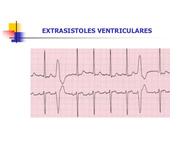 EXTRASISTOLES VENTRICULARES PDF DOWNLOAD
