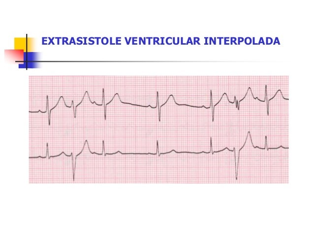 Arritmias ventriculares 2 dr jorge