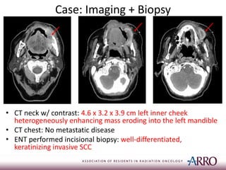 Oral Cavity Squamous Cell Carcinoma‏ OralCavity.ppt