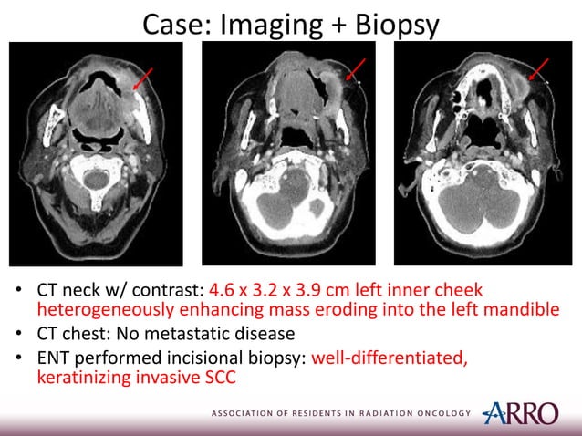 Oral Cavity Squamous Cell Carcinoma‏ OralCavity.ppt