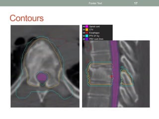 ARROCase_SpineSBRT (1).pdf