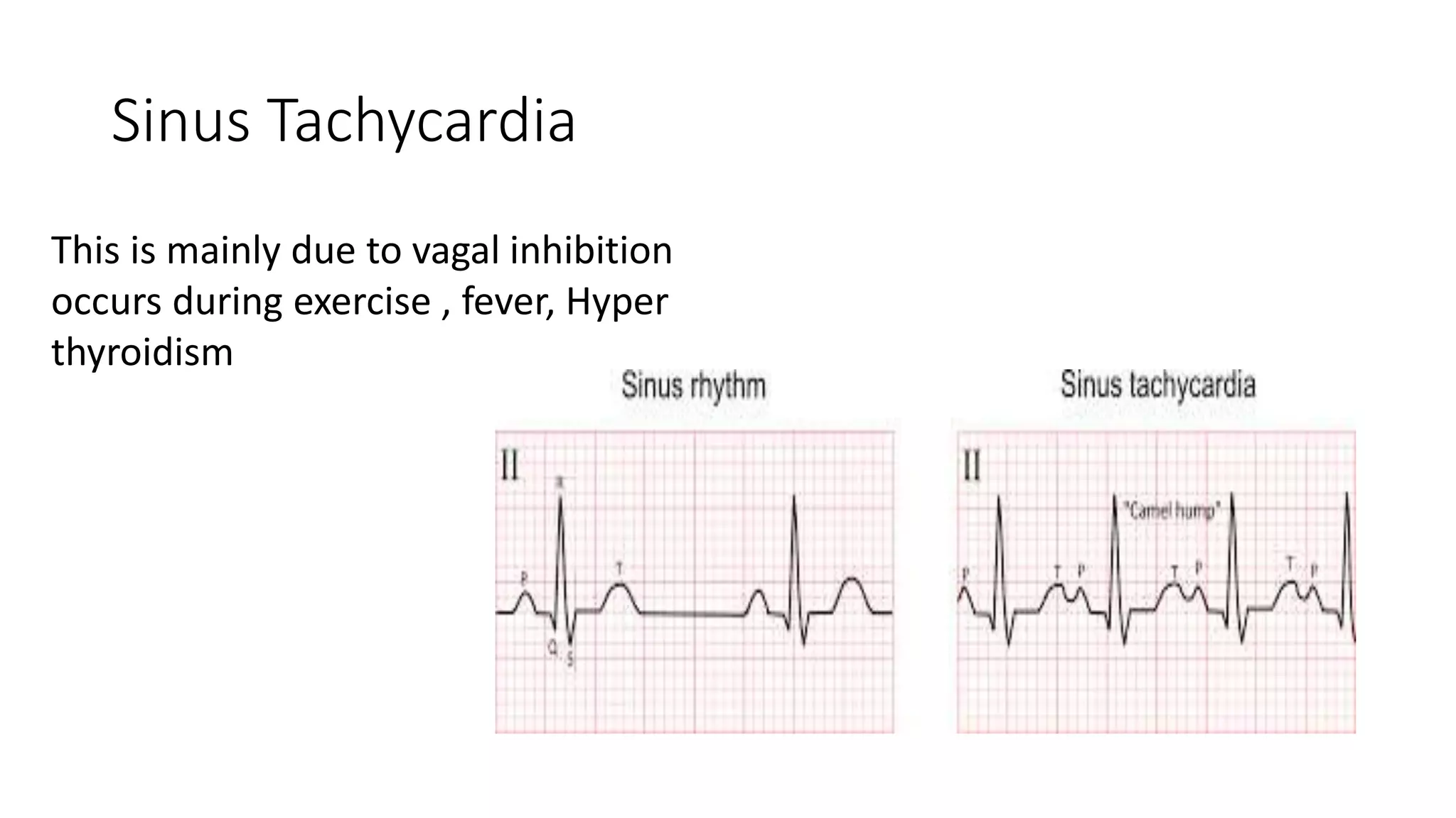 Types of Arrythmia and Anti Arrythmic Drugs .pptx