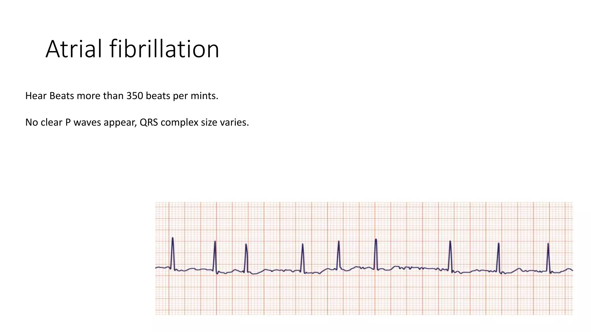 Types of Arrythmia and Anti Arrythmic Drugs .pptx