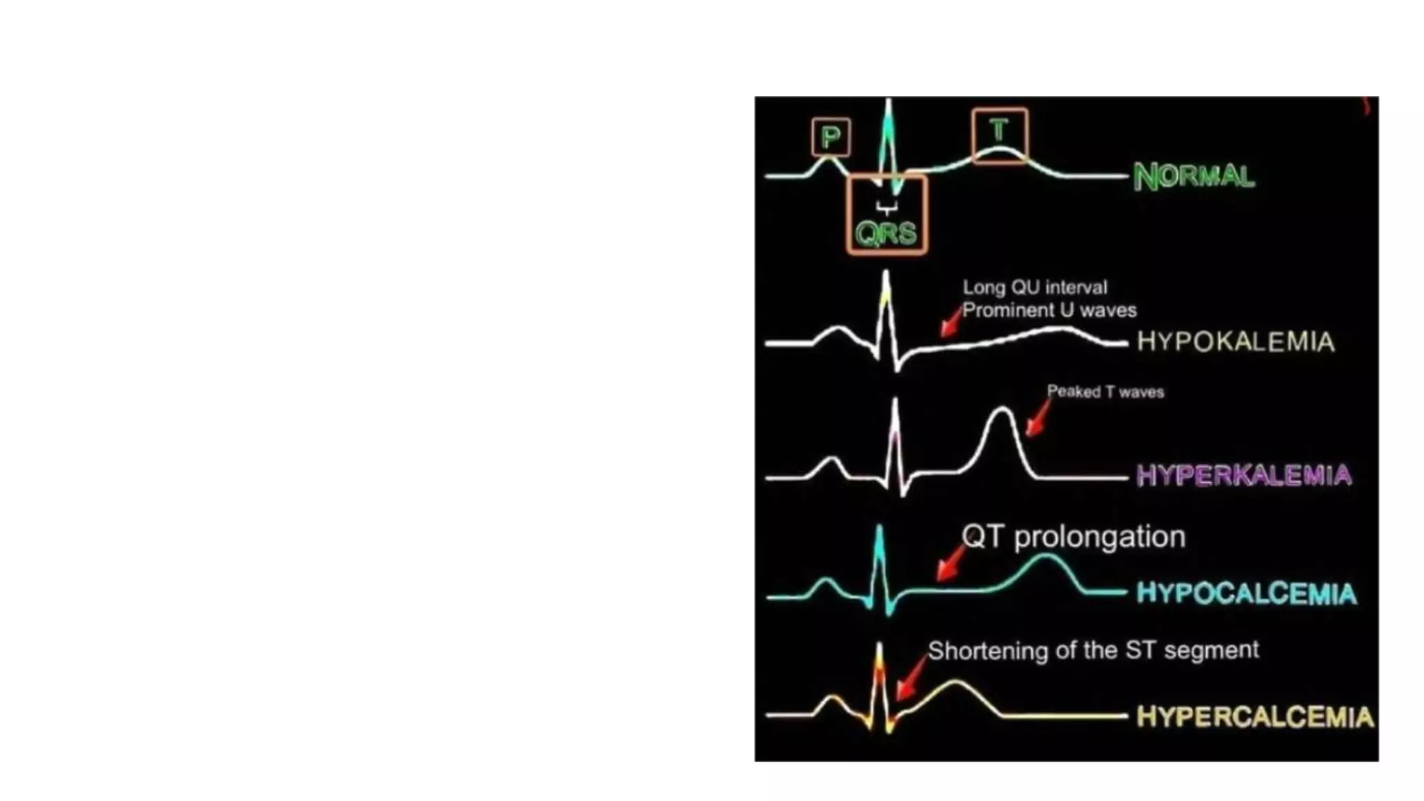 Types of Arrythmia and Anti Arrythmic Drugs .pptx