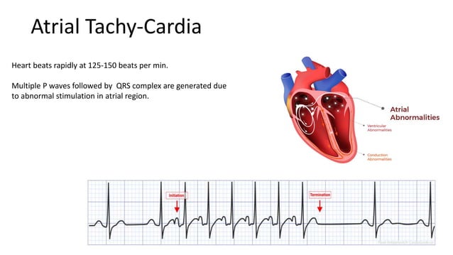 Types of Arrythmia and Anti Arrythmic Drugs .pptx