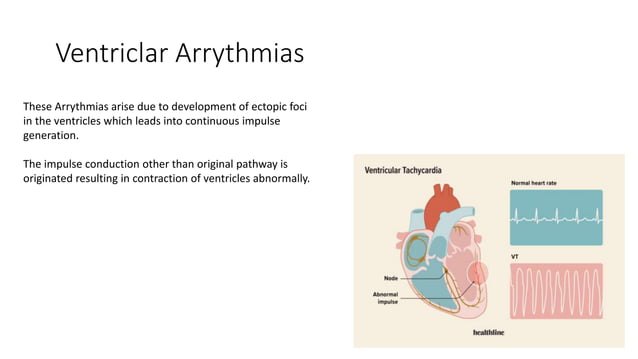 Types of Arrythmia and Anti Arrythmic Drugs .pptx