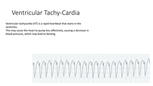 Types of Arrythmia and Anti Arrythmic Drugs .pptx