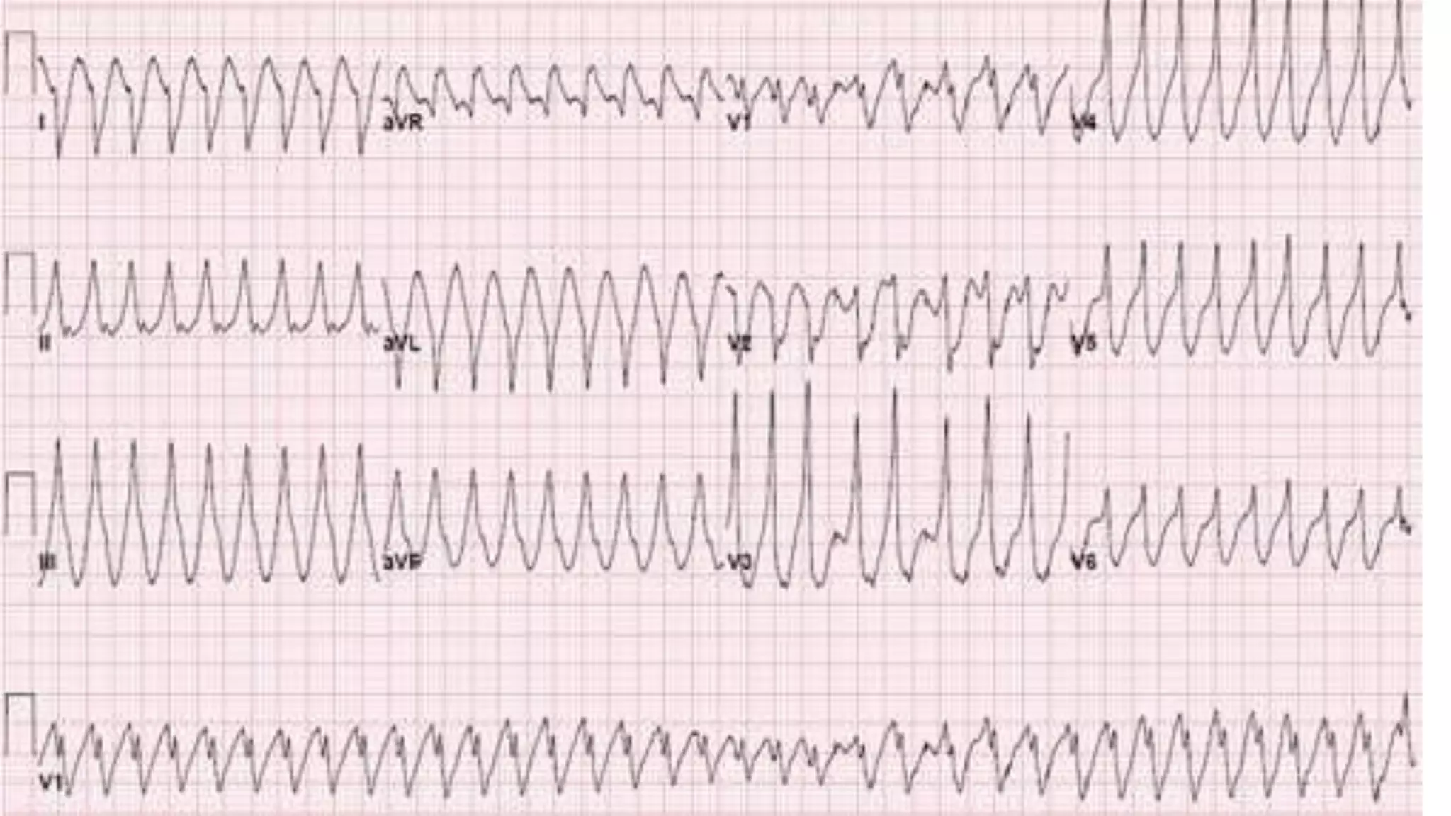 ARRYTHMIAS- narrow complex tachycardia’s .pptx