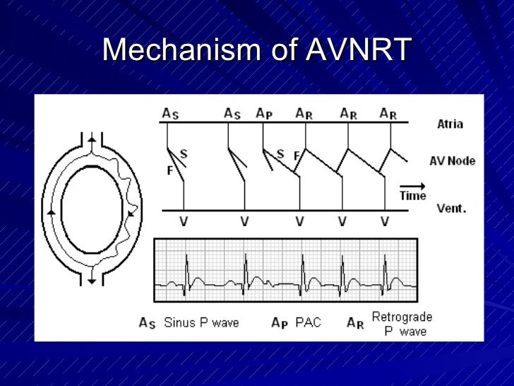 Arrythmias and ek gs 1