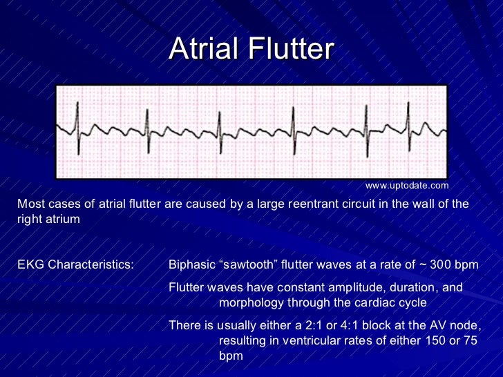 Arrythmias and ek gs 1