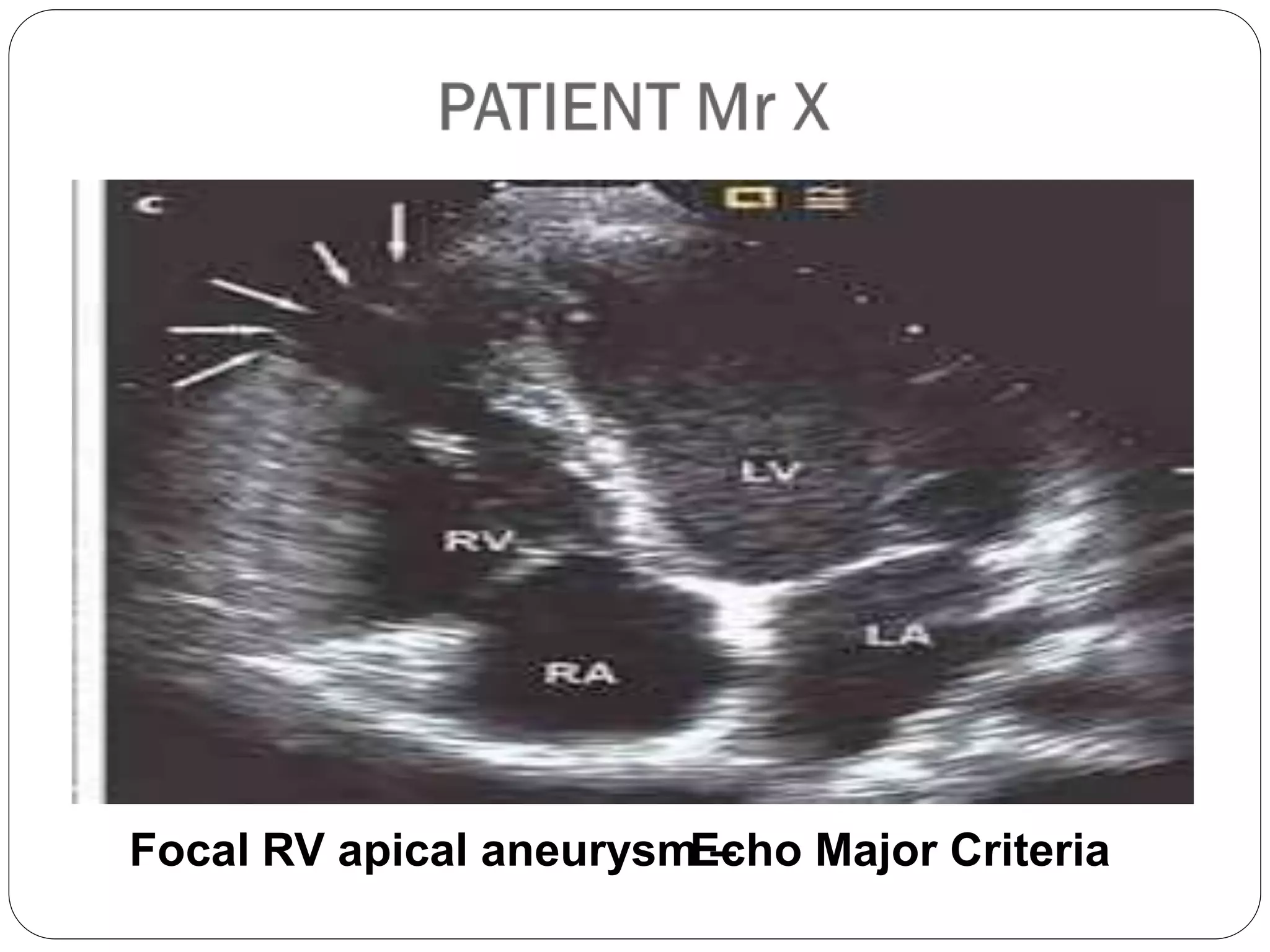 ARVD (Arrythmogenic right ventricular cardiomyopathy) - updated task ...