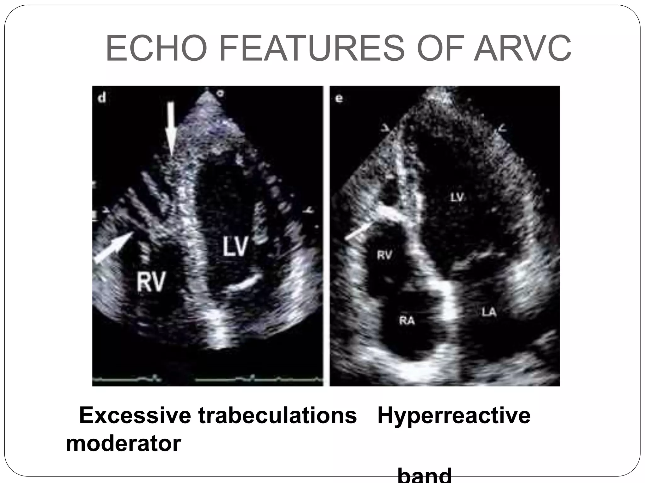 ARVD (Arrythmogenic right ventricular cardiomyopathy) - updated task ...