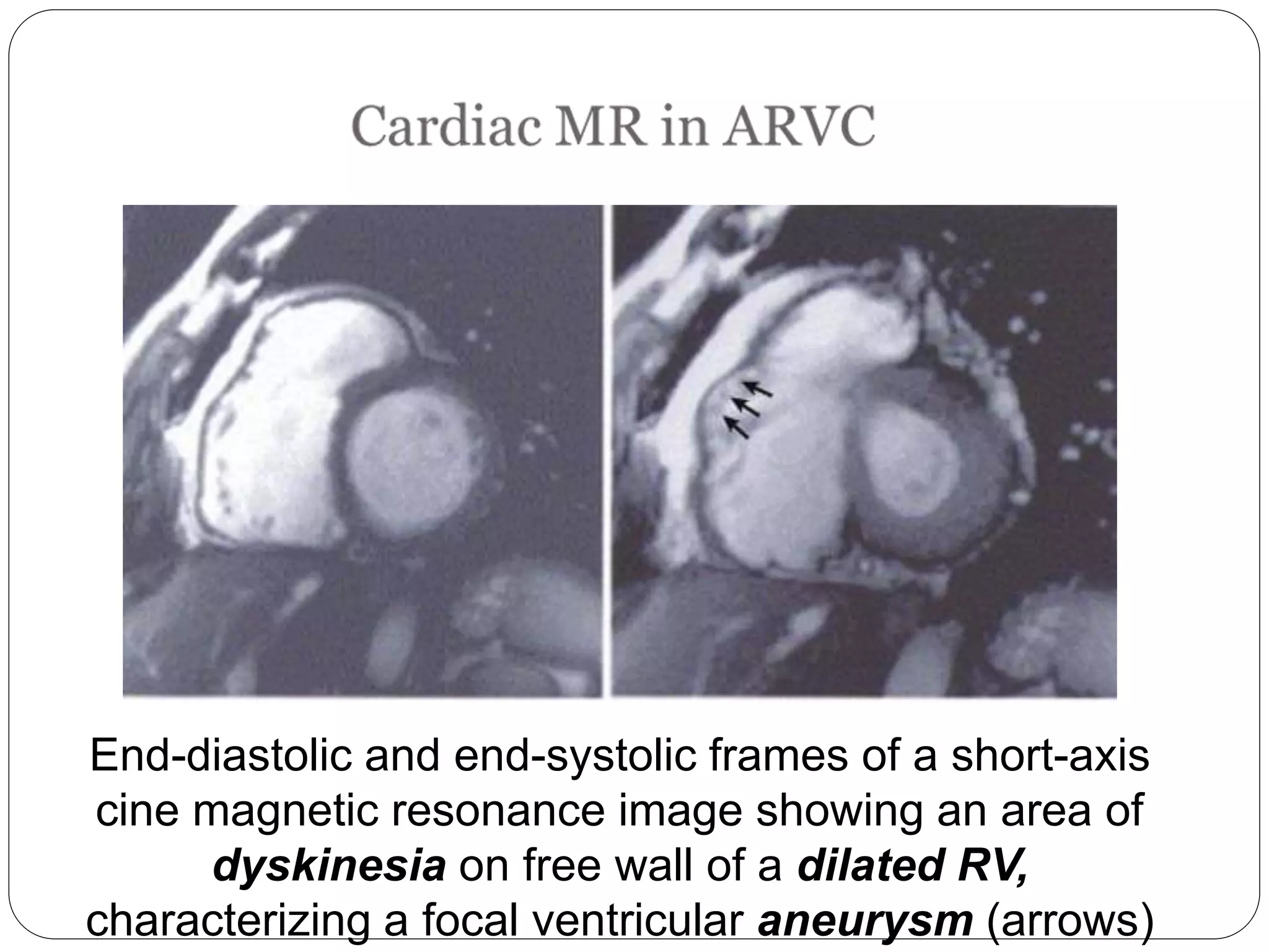 ARVD (Arrythmogenic right ventricular cardiomyopathy) - updated task ...