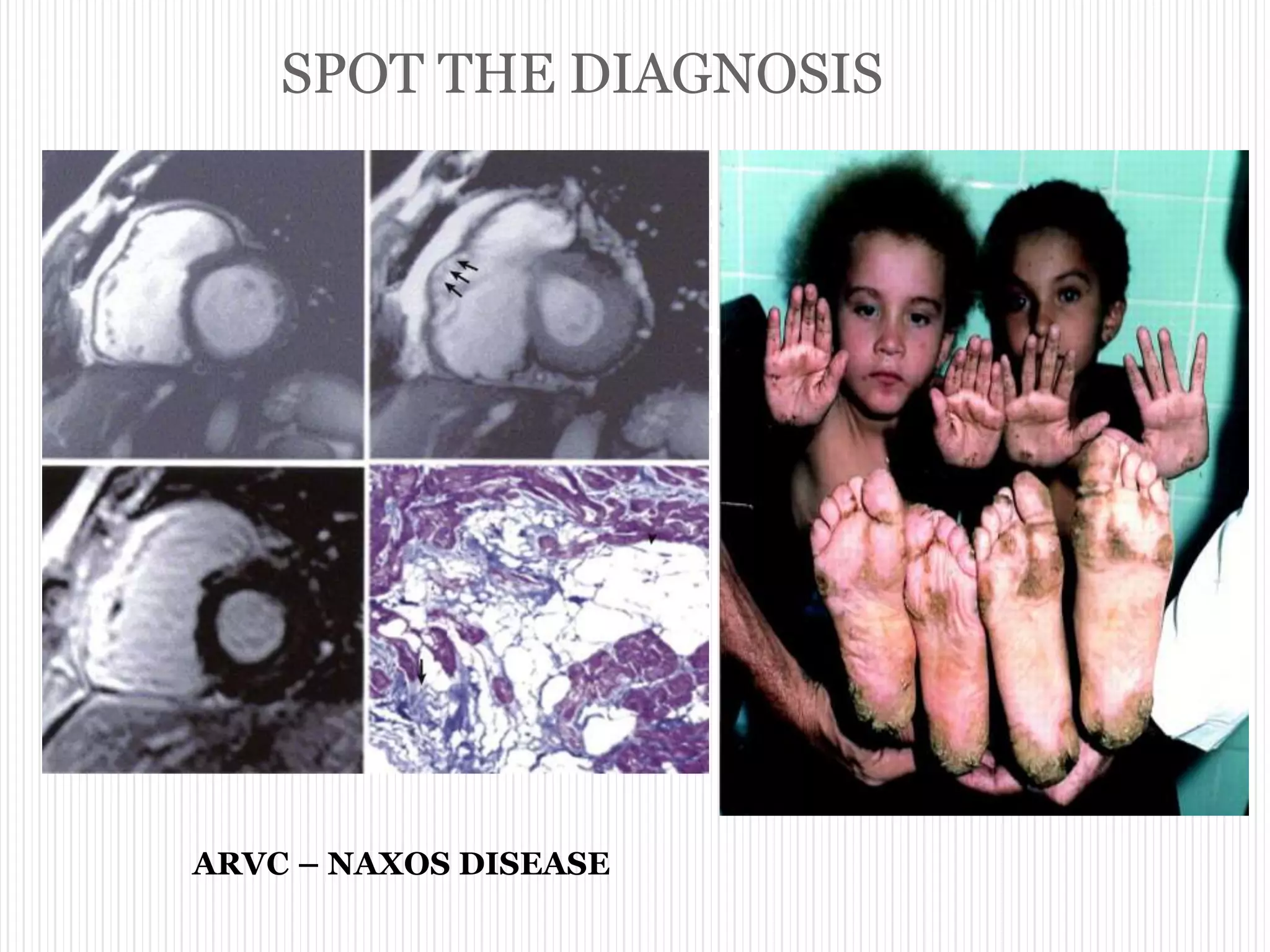 ARVD (Arrythmogenic right ventricular cardiomyopathy) - updated task ...