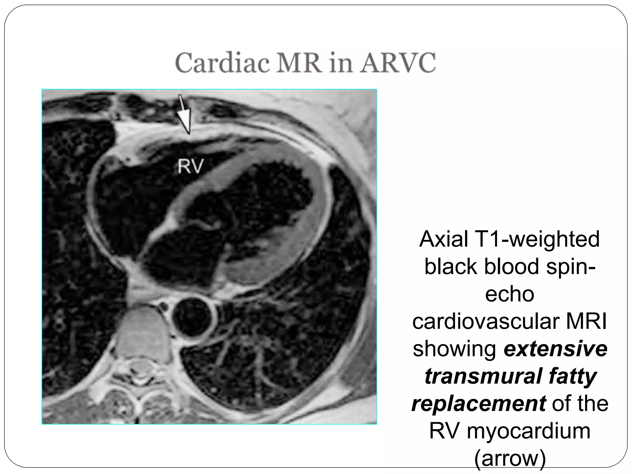 ARVD (Arrythmogenic right ventricular cardiomyopathy) - updated task ...