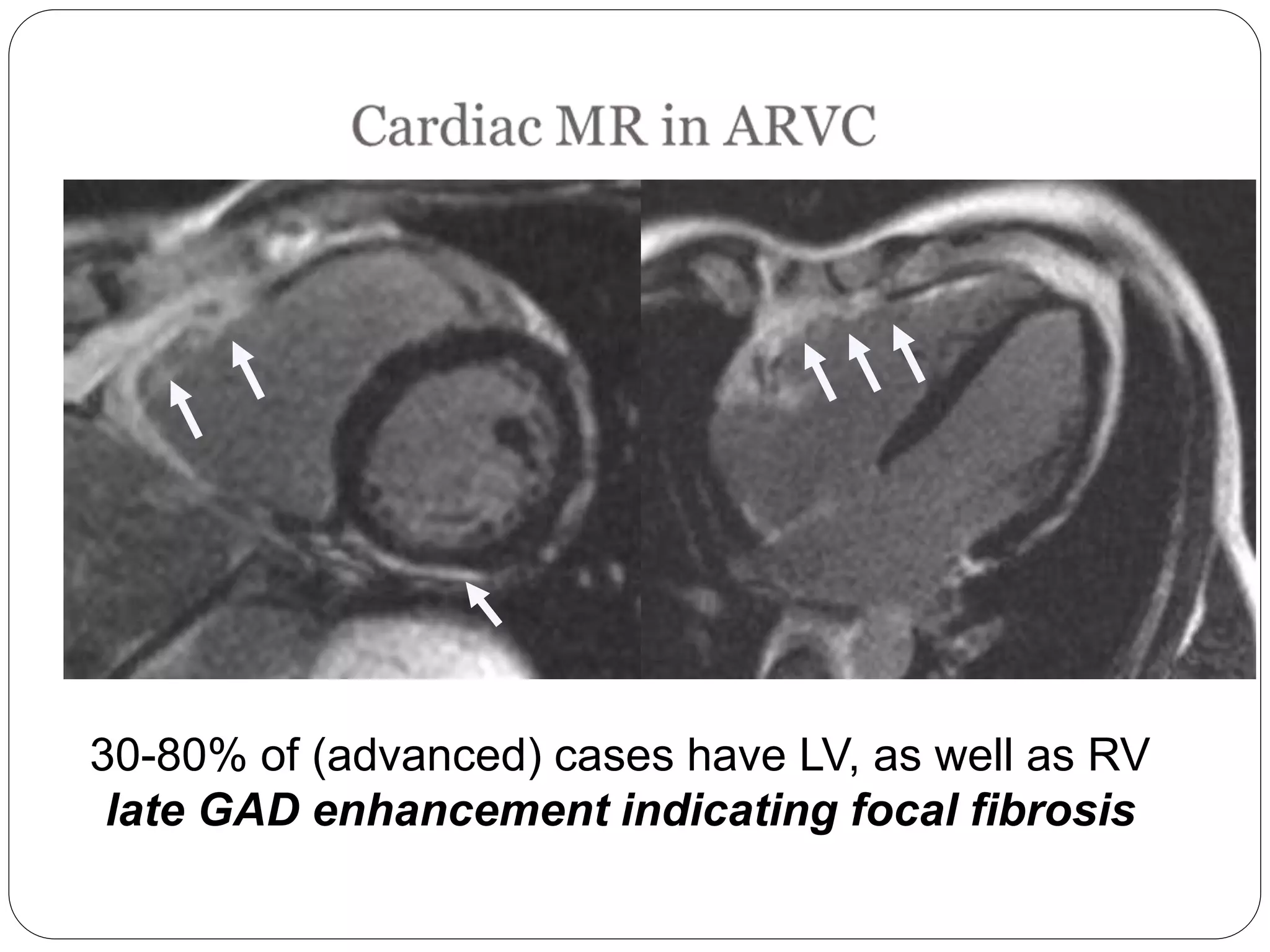 ARVD (Arrythmogenic right ventricular cardiomyopathy) - updated task ...