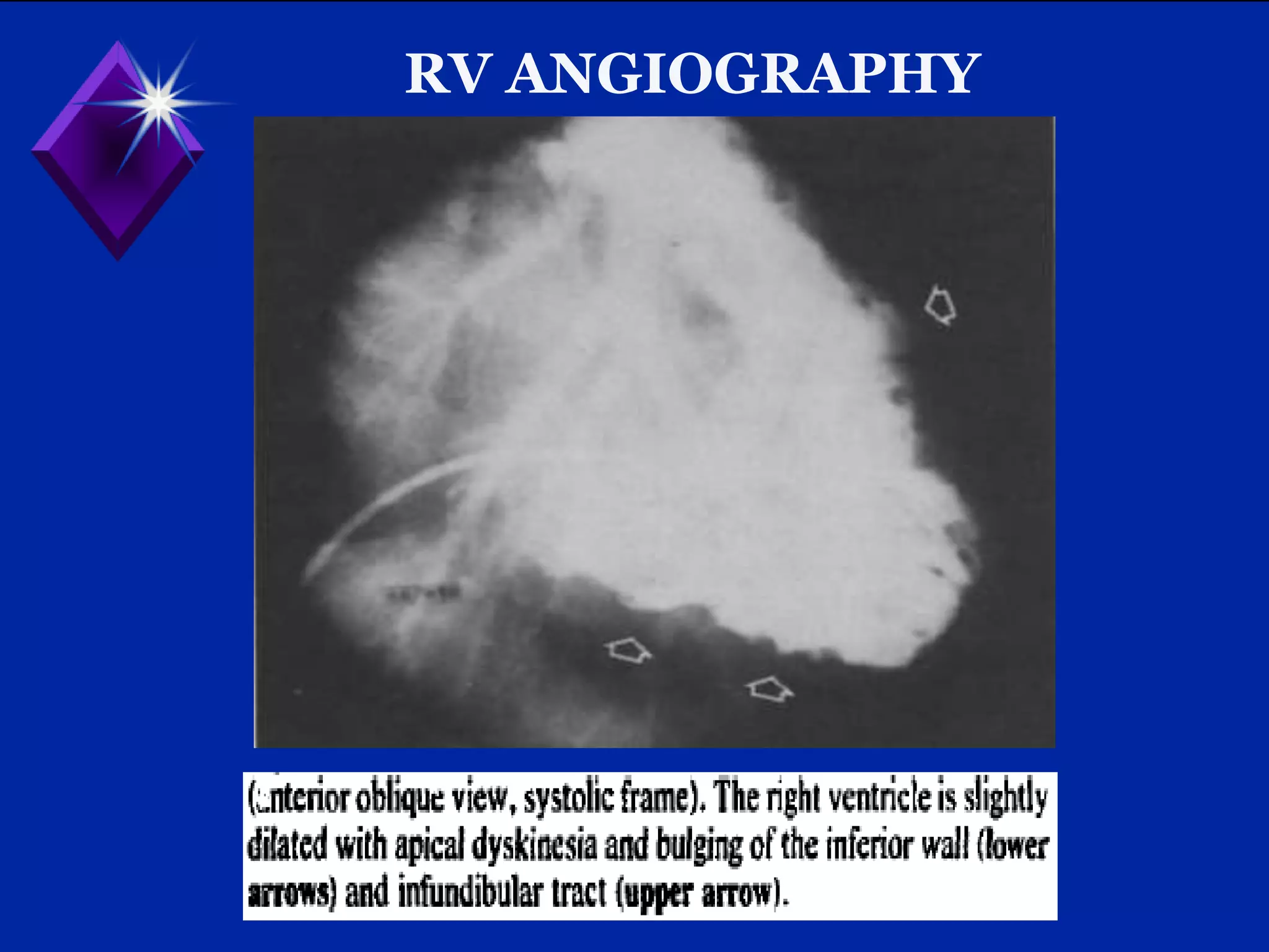 ARVD (Arrythmogenic right ventricular cardiomyopathy) - updated task ...