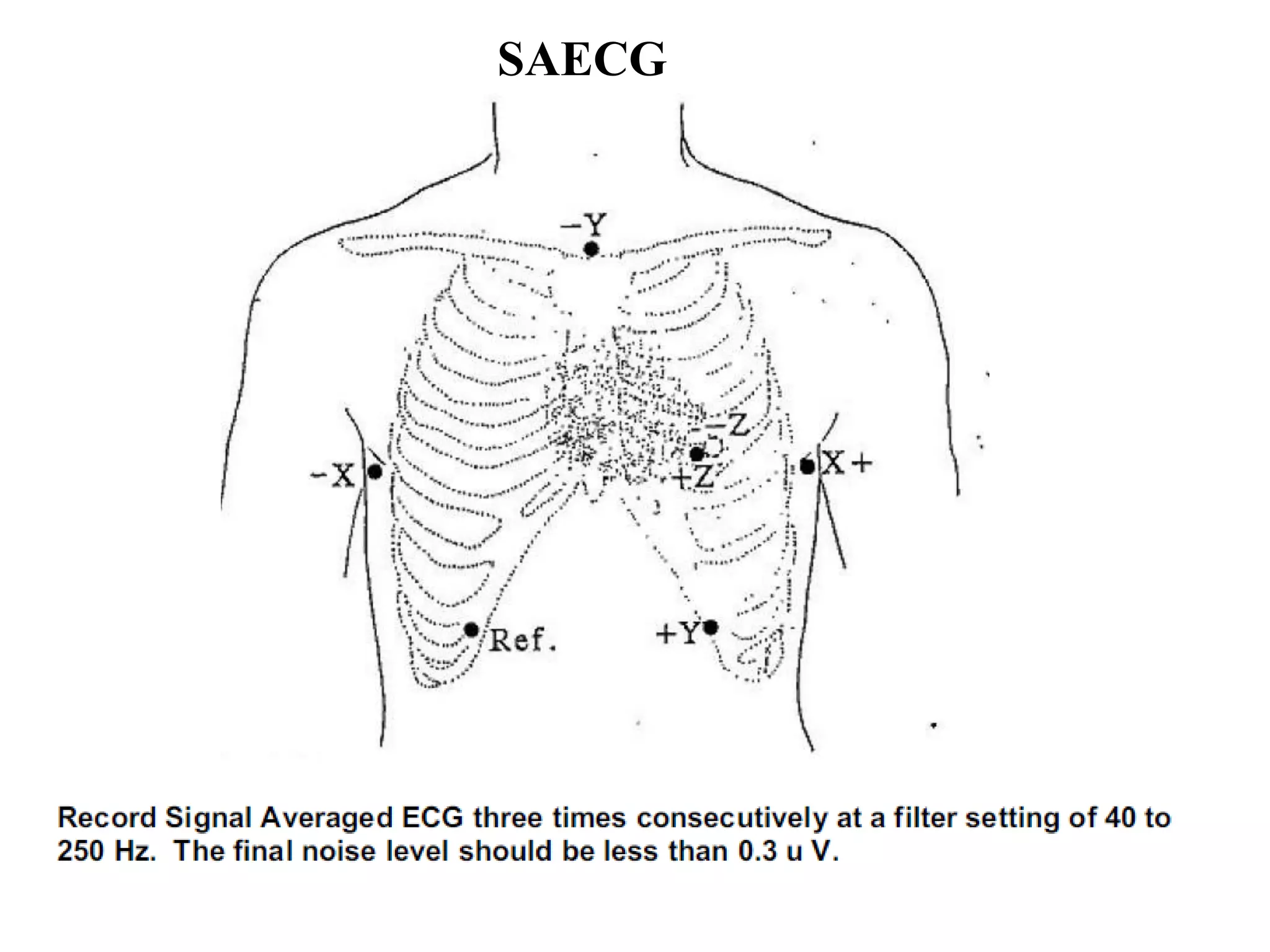 ARVD (Arrythmogenic right ventricular cardiomyopathy) - updated task ...