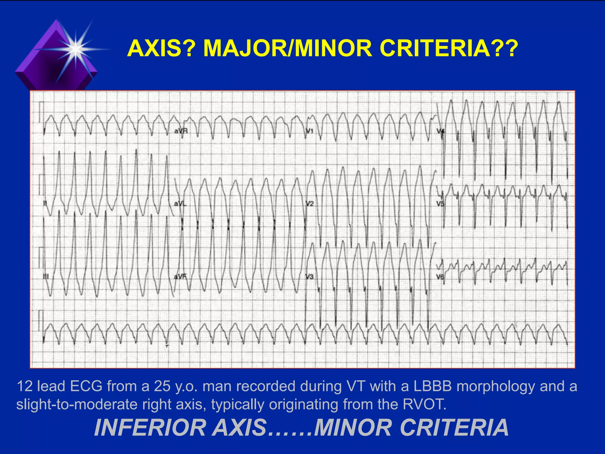 ARVD (Arrythmogenic right ventricular cardiomyopathy) - updated task ...