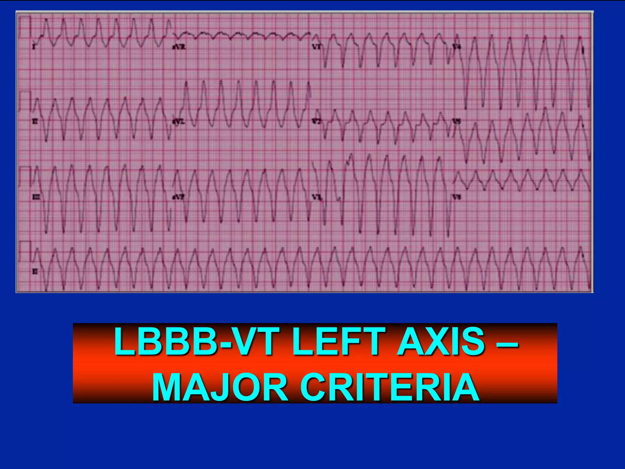 ARVD (Arrythmogenic right ventricular cardiomyopathy) - updated task ...