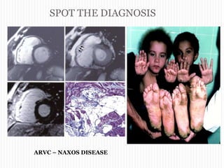 ARVD (Arrythmogenic right ventricular cardiomyopathy) - updated task ...