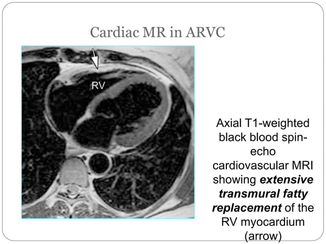 ARVD (Arrythmogenic right ventricular cardiomyopathy) - updated task ...