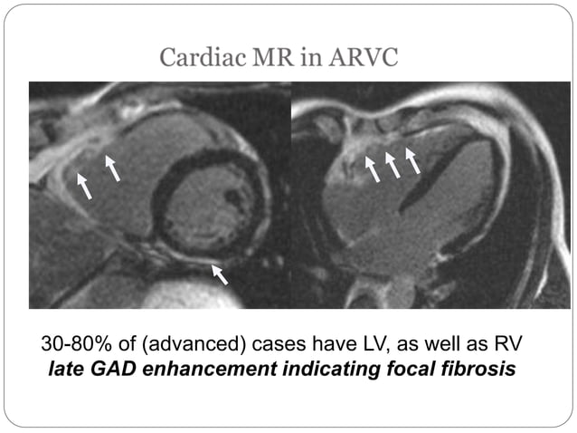 ARVD (Arrythmogenic right ventricular cardiomyopathy) - updated task ...