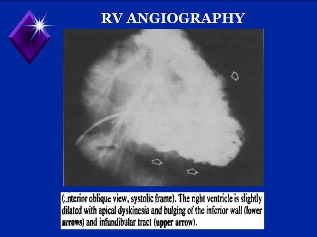 ARVD (Arrythmogenic right ventricular cardiomyopathy) - updated task ...
