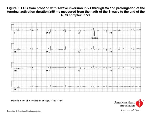 ARVD (Arrythmogenic right ventricular cardiomyopathy) - updated task ...