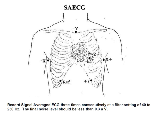 ARVD (Arrythmogenic right ventricular cardiomyopathy) - updated task ...