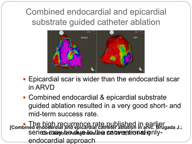 ARVD (Arrythmogenic right ventricular cardiomyopathy) - updated task ...
