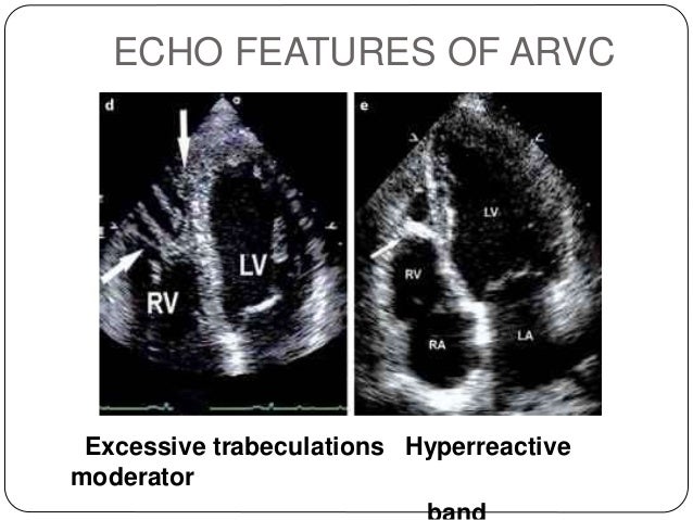 ARVD (Arrythmogenic right ventricular cardiomyopathy) - updated task