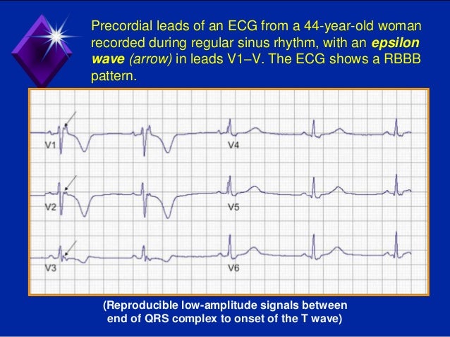 ARVD (Arrythmogenic right ventricular cardiomyopathy) - updated task