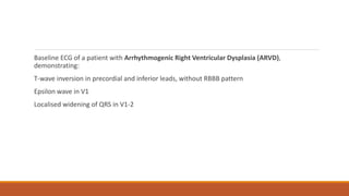 Arrythmogenic rv dysplasia (ARVD) | PPTX