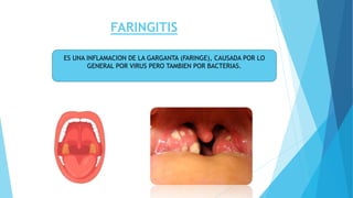 INFECCIONES DE VIAS AEREAS SUPERIORES | PPTX