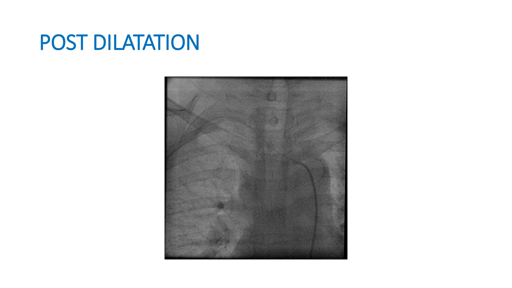 STENOSIS OF ABBERANT RIGHT SUBCLAVIAN ARTERY WITH KOMMERELL ...