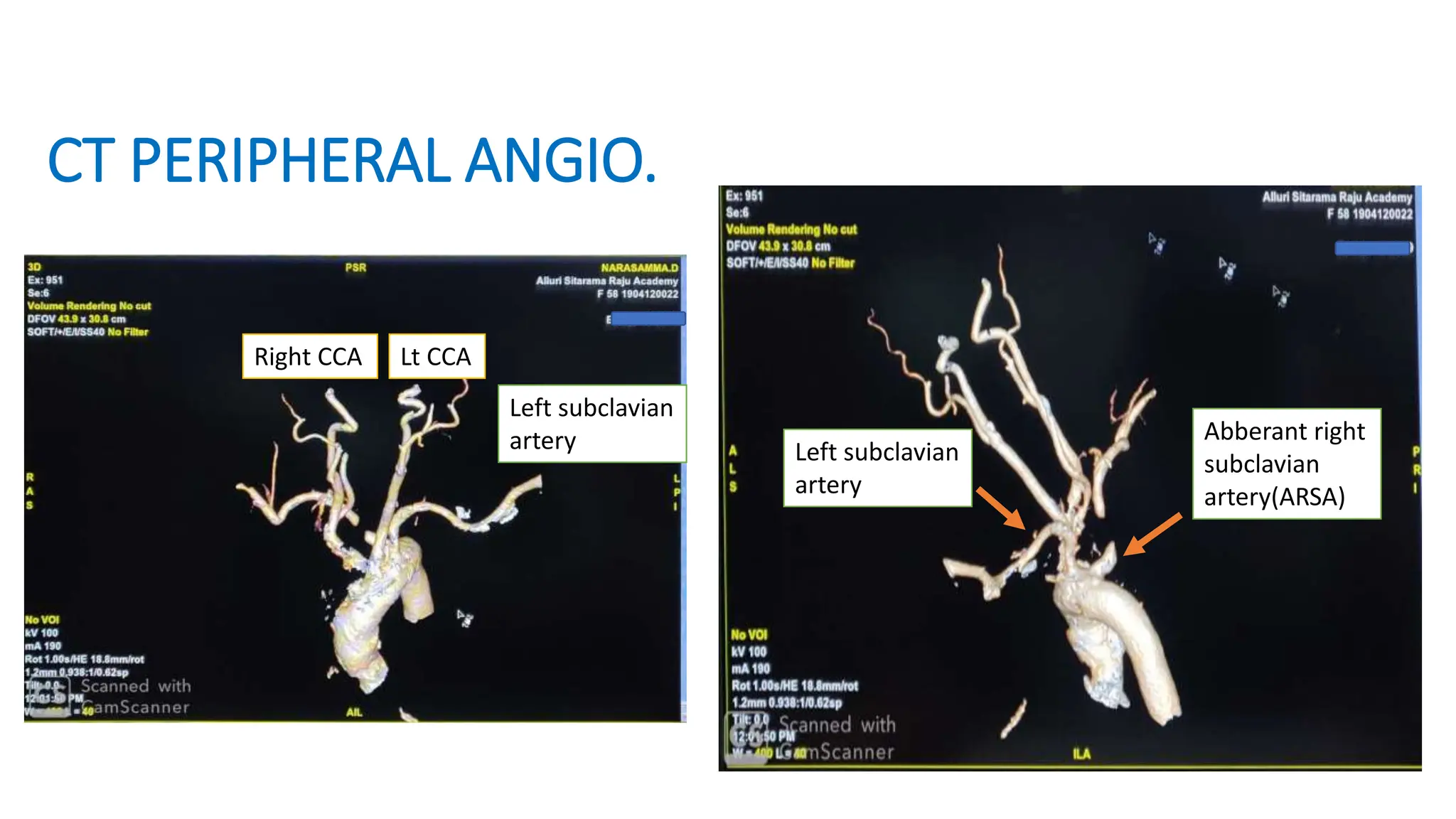STENOSIS OF ABBERANT RIGHT SUBCLAVIAN ARTERY WITH KOMMERELL ...