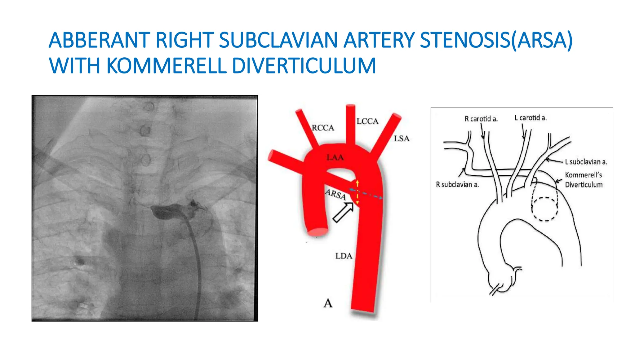 STENOSIS OF ABBERANT RIGHT SUBCLAVIAN ARTERY WITH KOMMERELL ...