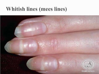 Arsenic Poisoning Fingernail Signs