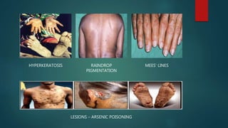 Arsenic poisoning - heavy metal poisoning - clinical toxicology | PPTX