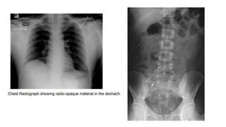 ARSENIC POISONING - A FORENSIC MEDICINE PRESENTATION | PPTX
