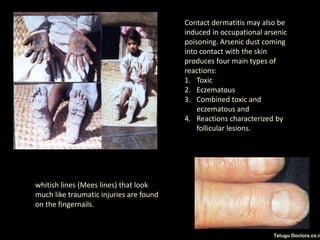 Poisoning_Arsenic_poisoning _pharmacology.ppt