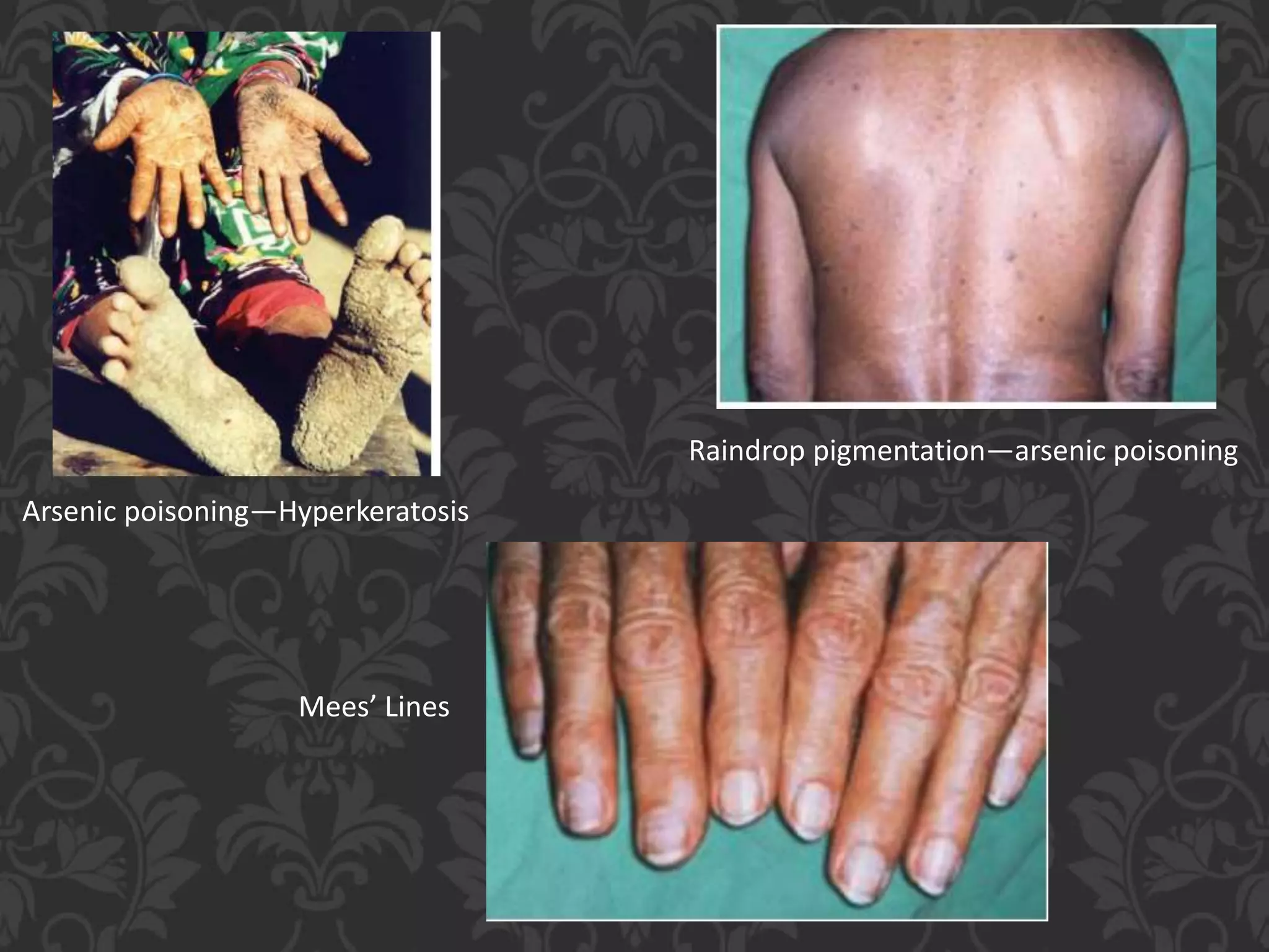 Arsenic trioxide poisoning | PPT