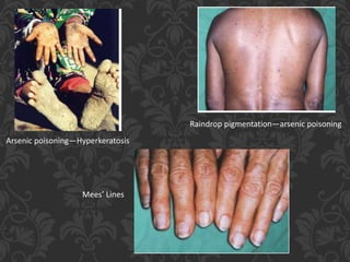 Arsenic trioxide poisoning | PPT