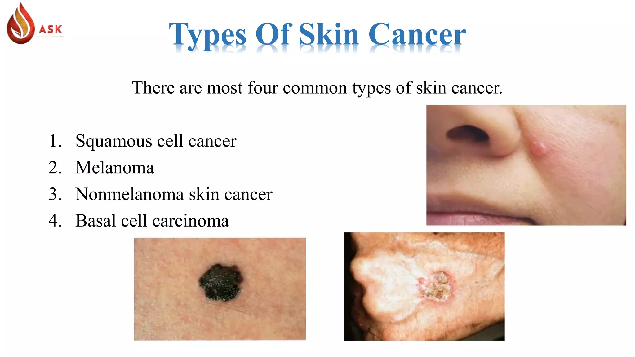 Skin Cancer | PPTX